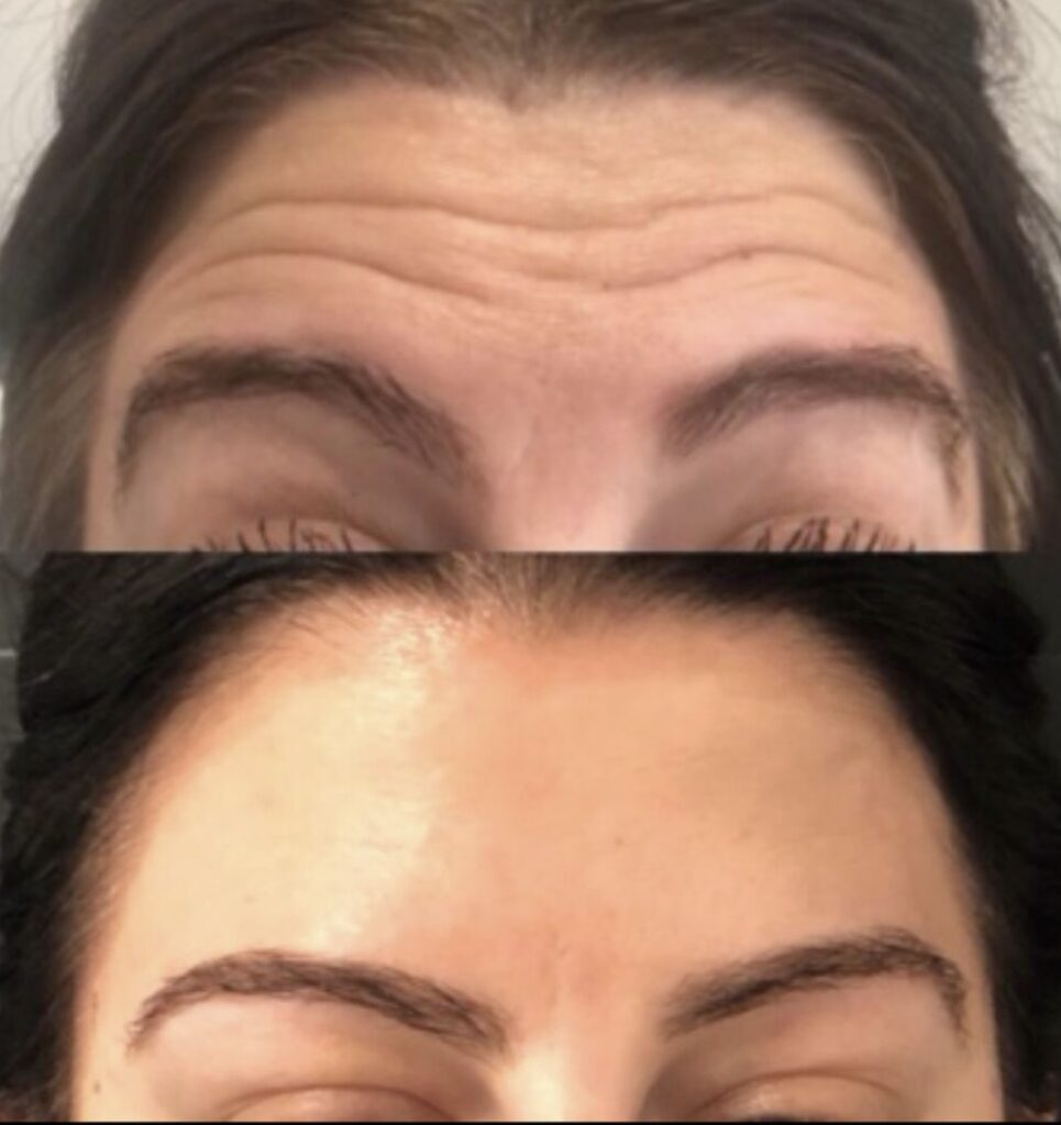 BOTOX Kleinburg | PARK LANE MEDSPA | Natural & Brilliant